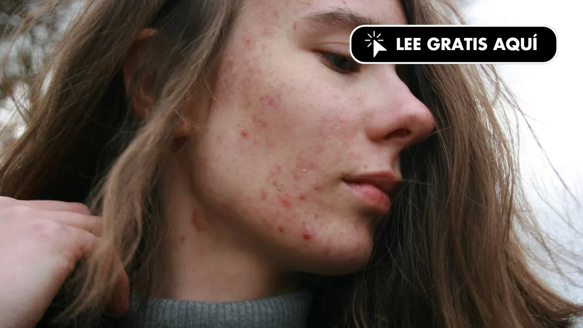 ¿Cómo puede cambiar la piel con un brote de acné?