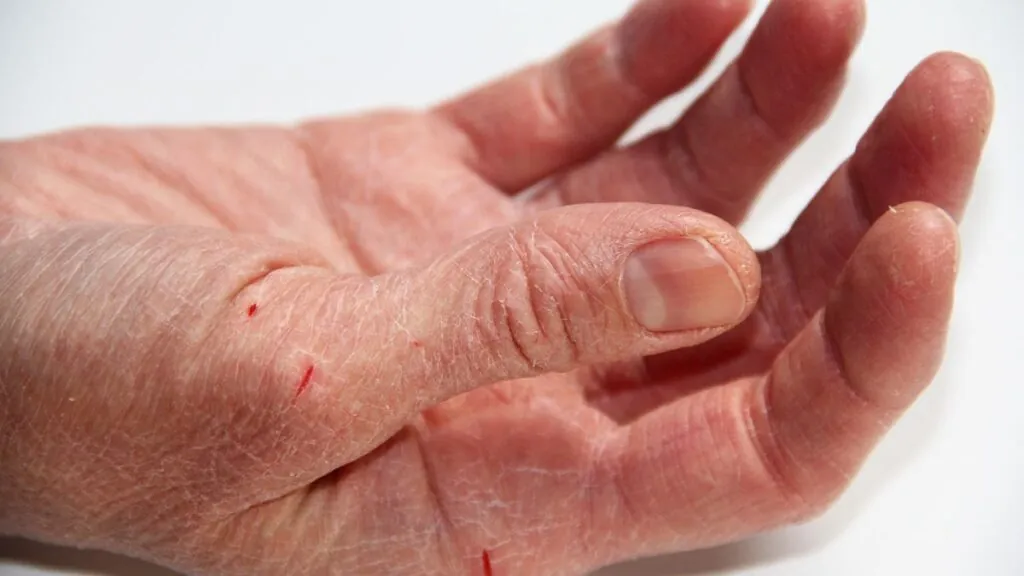 Tengo las manos agrietadas y esta es la enfermedad que puedo padecer