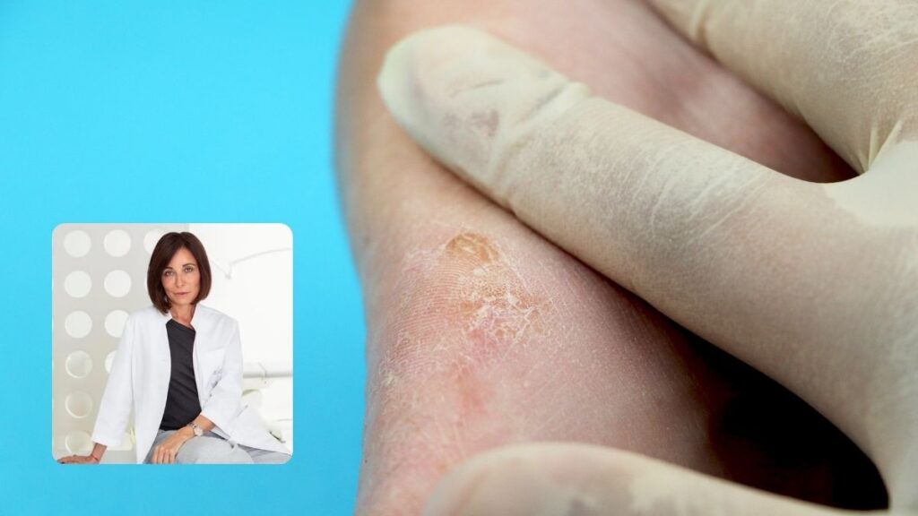 Moluscos en la piel: por qué aparecen, cómo eliminarlos de forma segura