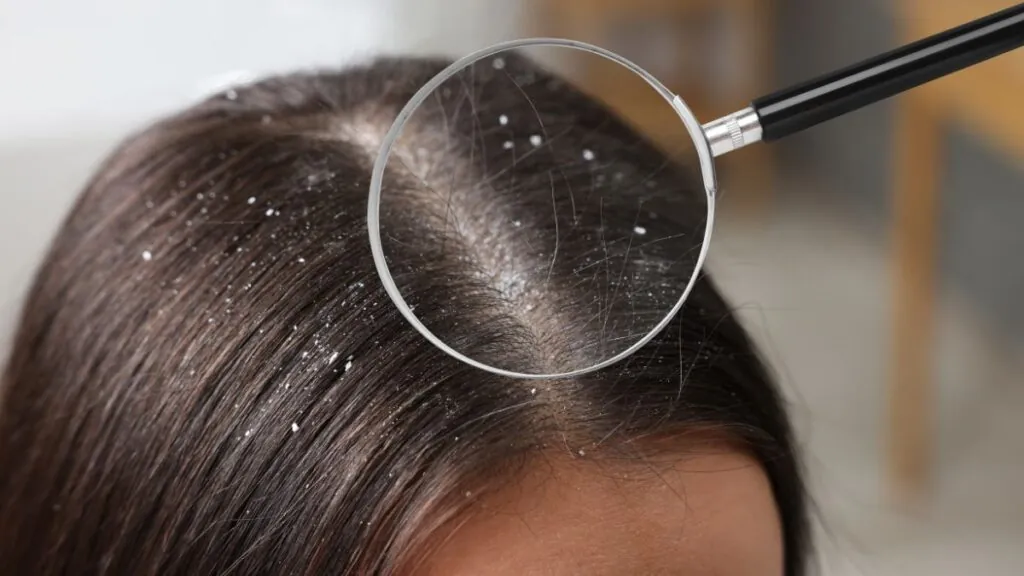 Isabel Barrado, peluquera: «El truco definitivo para combatir la caspa ...